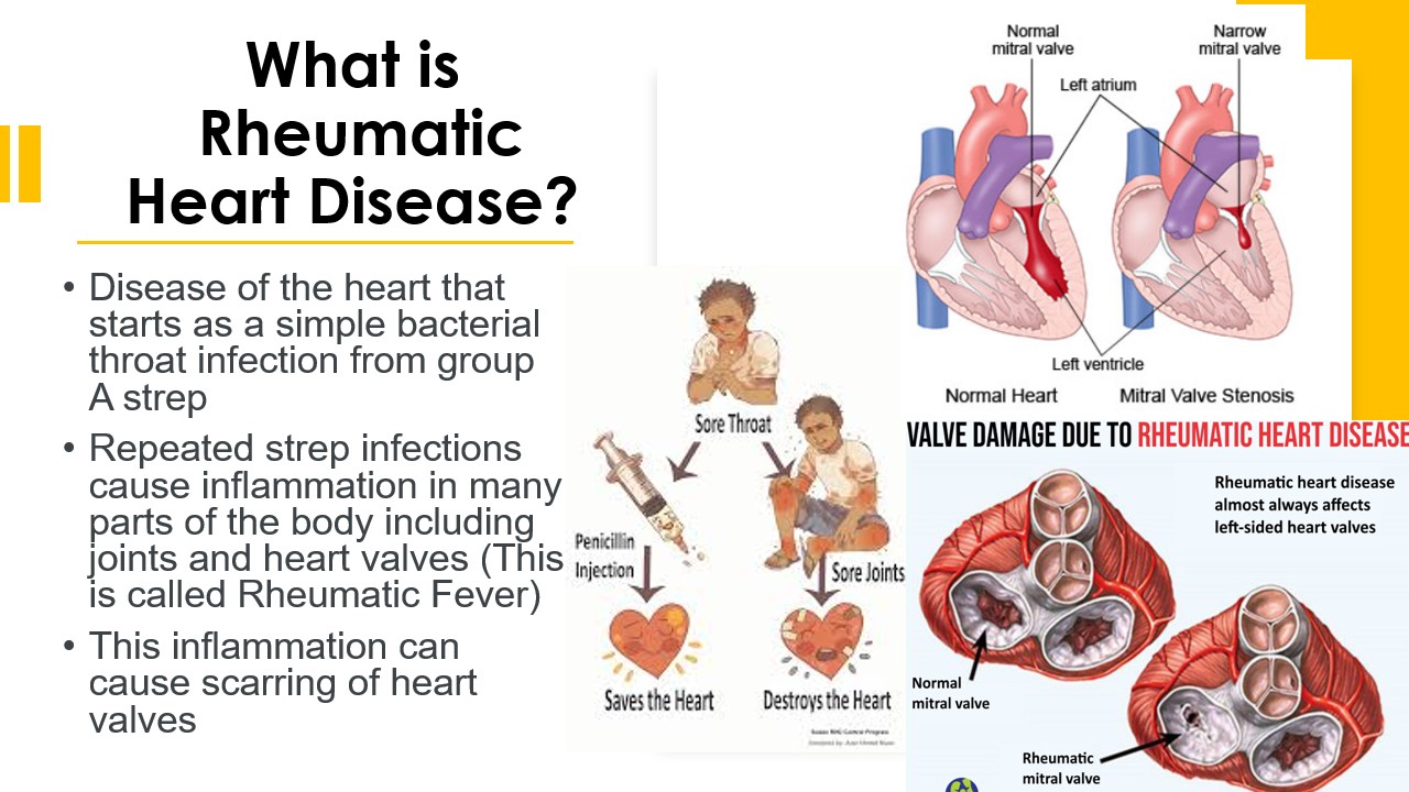 About RHD – Rheumatic Heart Disease – Eyob Hope for Children and Youth